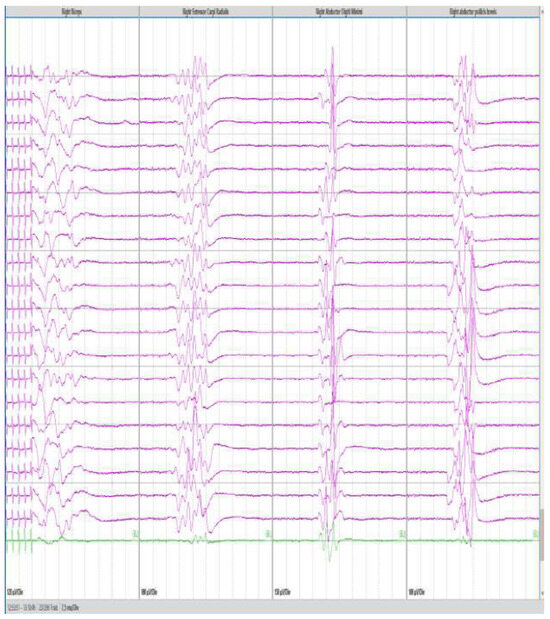 Intraoperative Neurophysiological Monitoring in Neurosurgery