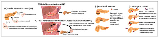 Challenges of Managing Type 3c Diabetes in the Context of Pancreatic ...