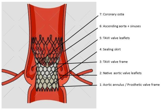 Transcatheter Aortic Valve Implantation for Severe Chronic Aortic ...