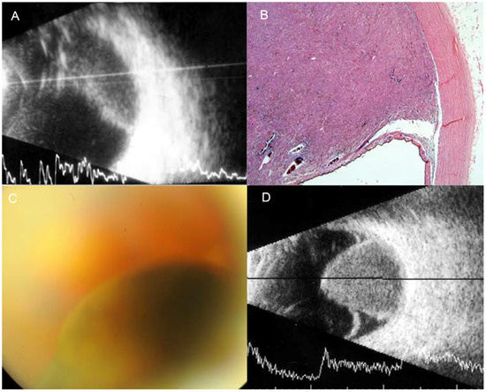 Bilateral Uveal Melanoma: An Insight into Genetic Predisposition in ...