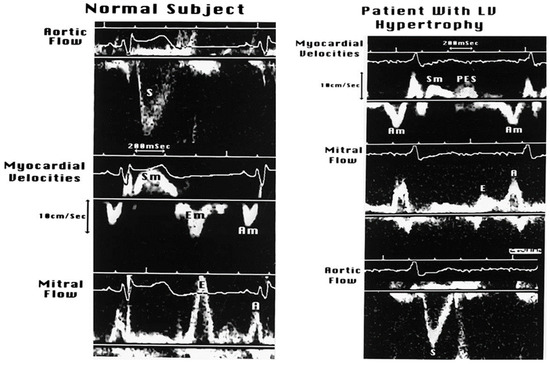 Diastolic Heart Failure Mechanisms and Assessment Revisited