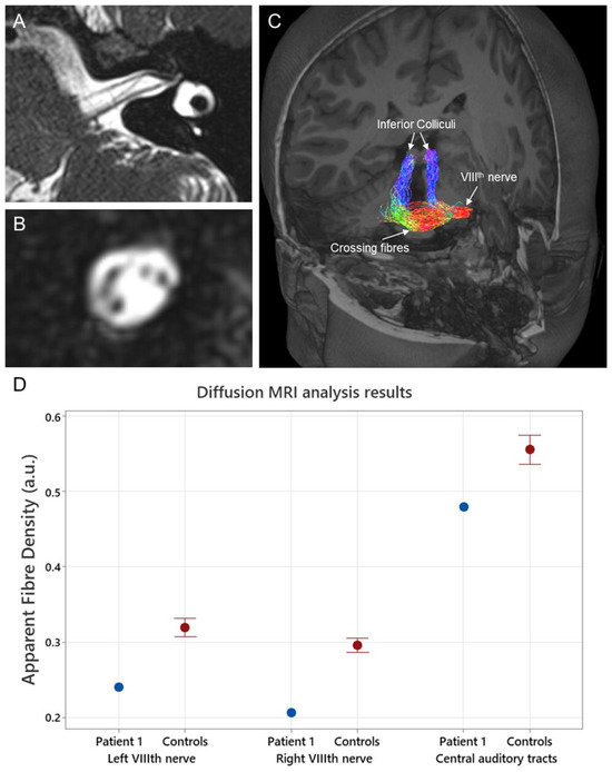 Diffusion-Weighted Magnetic Resonance Imaging (dMRI) and Cochlear Implant Outcomes in Axonal ...
