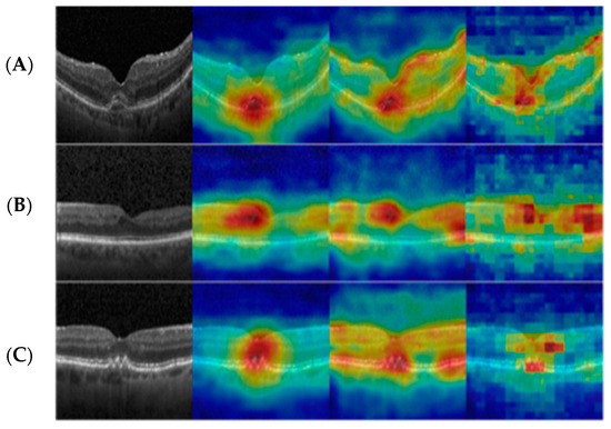 Anomaly Detection and Biomarkers Localization in Retinal Images