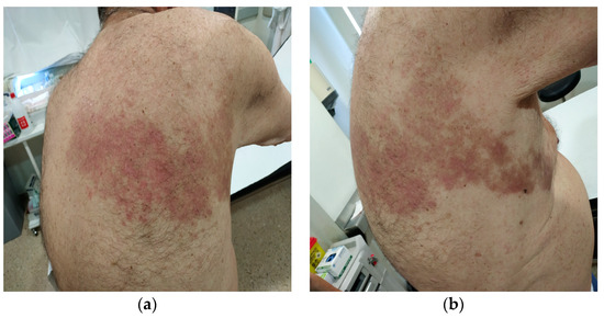 Increased Risk of Herpes Zoster in Rheumatoid Arthritis Not Only Due to ...