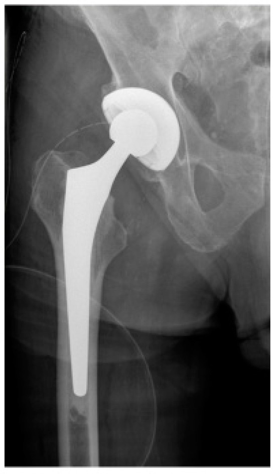 Early Postoperative Weight-Bearing Ability after Total Hip Arthroplasty ...