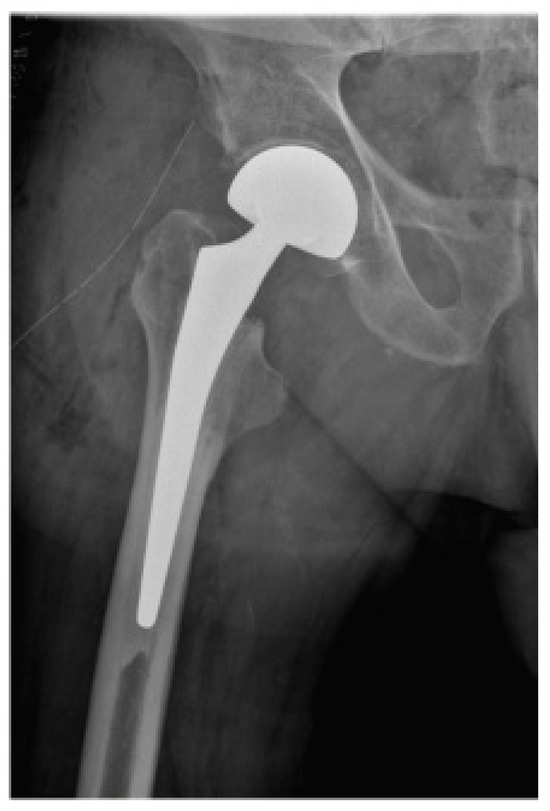 Early Postoperative Weight-Bearing Ability after Total Hip Arthroplasty ...
