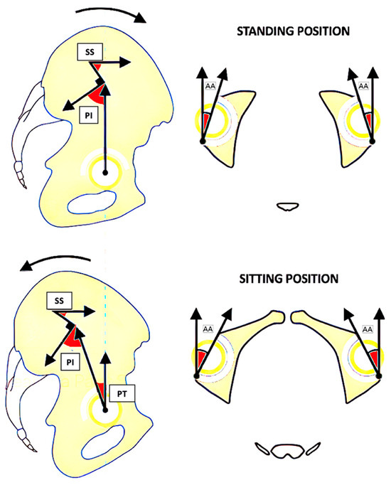 Challenges in Total Hip Arthroplasty with Prior Spinal Arthrodesis: A ...