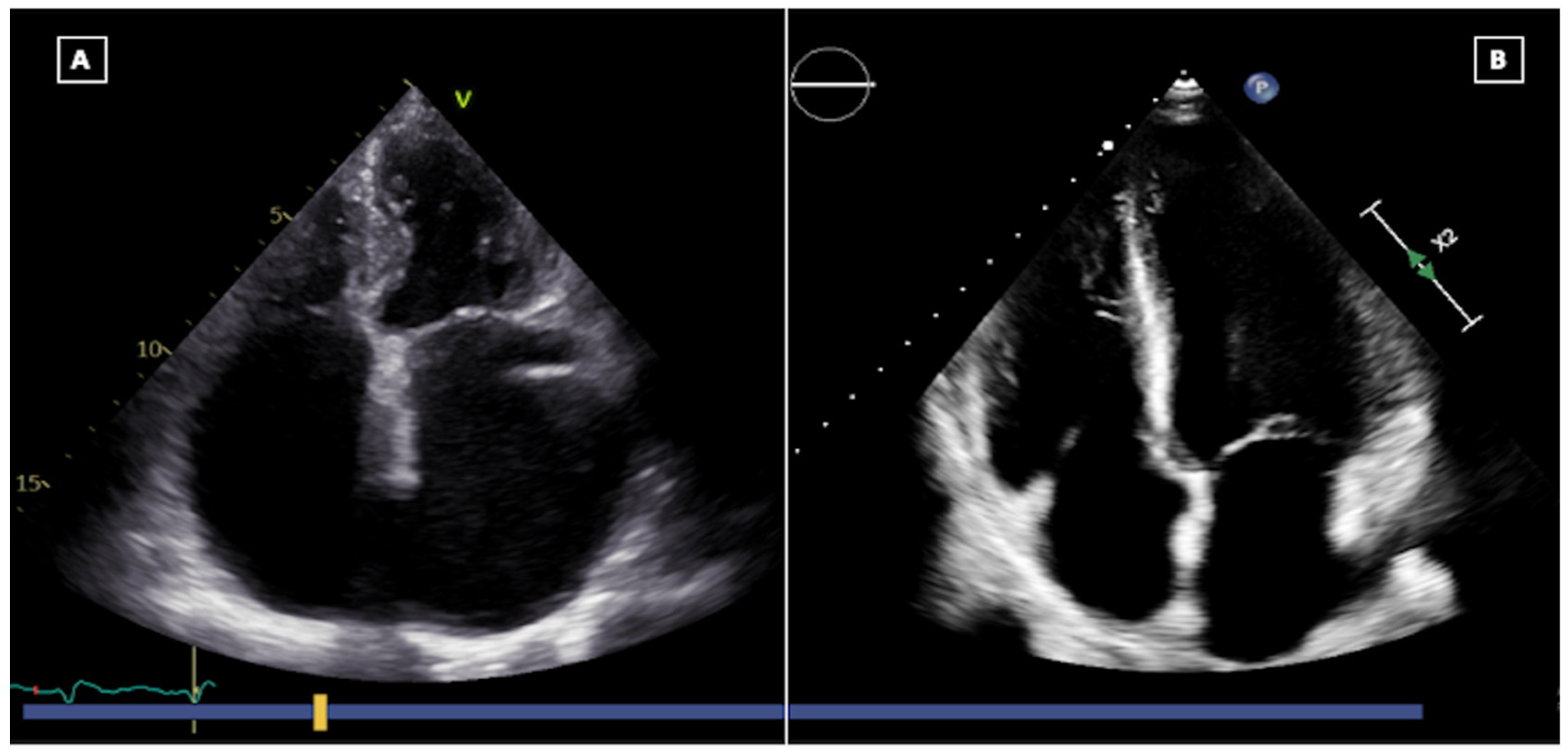 A Comprehensive Excursus of the Roles of Echocardiography in Heart ...