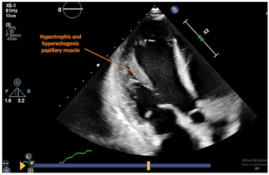 A Comprehensive Excursus of the Roles of Echocardiography in Heart ...