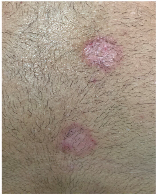 Tinea Incognito: Challenges in Diagnosis and Management