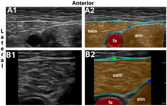 Femoral Nerve Block