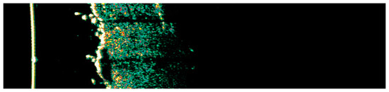 Pilot Study on High-Intensity Focused Ultrasound (HIFU) for Basal Cell ...