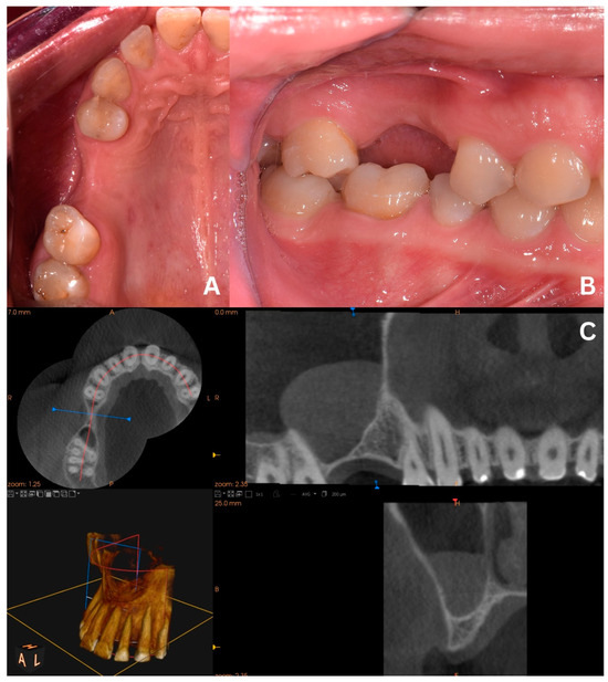 Submucosal Retention Cyst Endoscopic Sinus Surgery For Maxillary Sinus