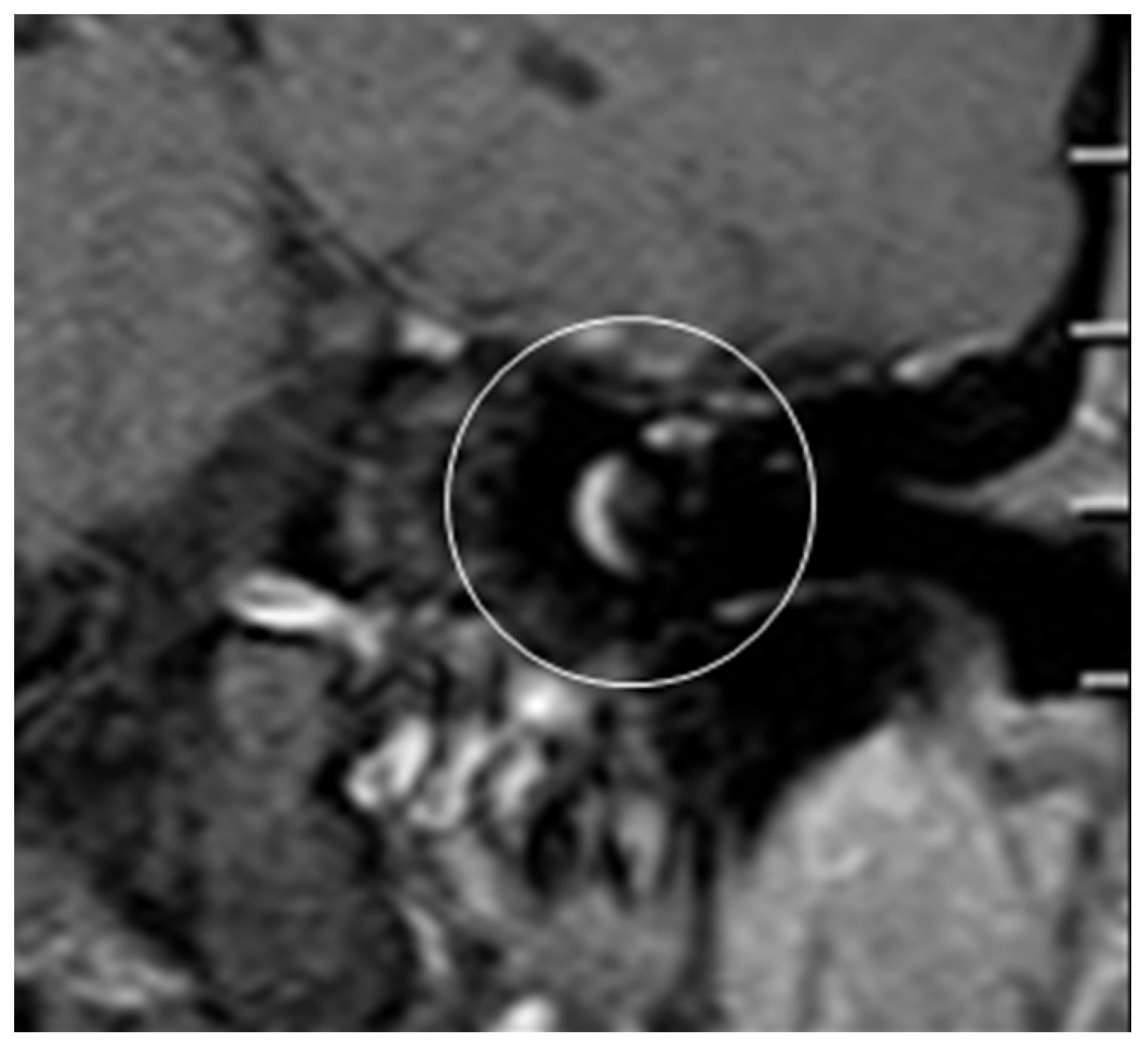 First Clinical Experience with a New Device for the Removal of Cochlear ...