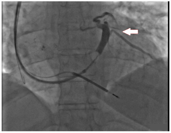 Left Bundle Branch Area Pacing to Overcome Coronary Sinus Anatomy ...