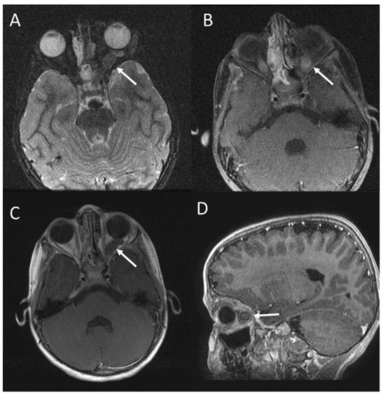 Magnetic Resonance Imaging of Central Nervous System Manifestations of ...