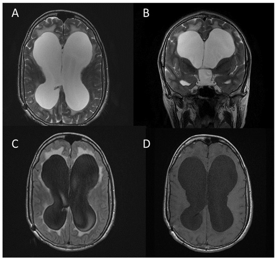 Magnetic Resonance Imaging of Central Nervous System Manifestations of ...