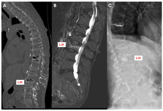 From Detection to Decision: How STIR Sequence MRI Influences Treatment ...