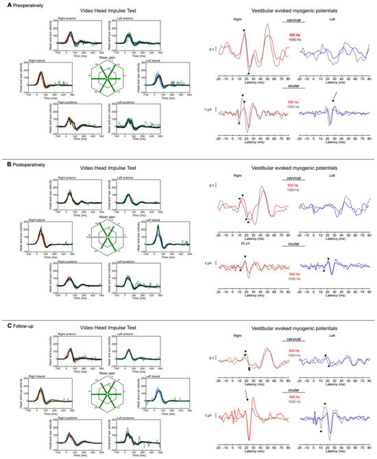 A Case Report Demonstrating Preservation of Vestibular Receptor ...