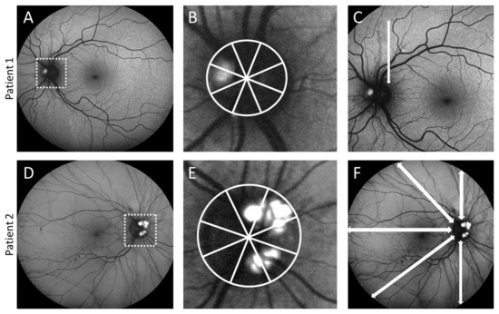 Optic Disc Drusen in Pseudoxanthoma Elasticum Are Associated with the ...