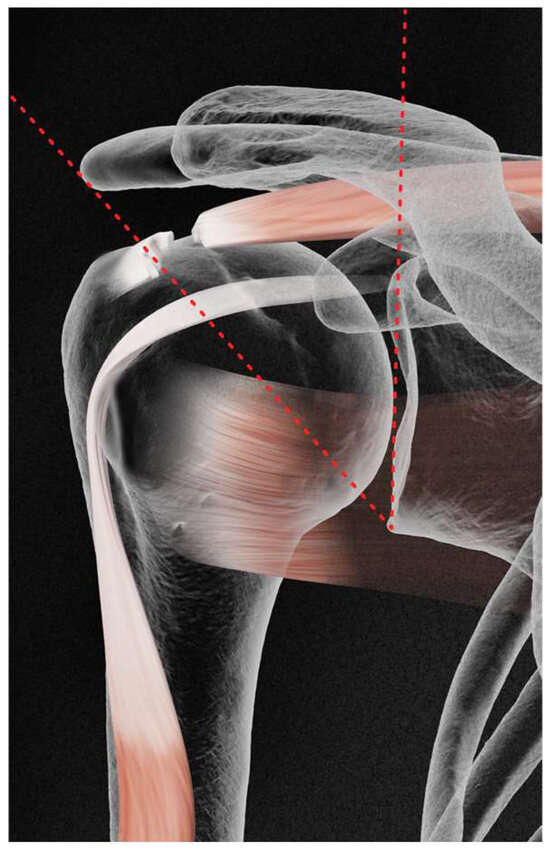 The Critical Shoulder Angle: A Significant Radiological Measure in ...