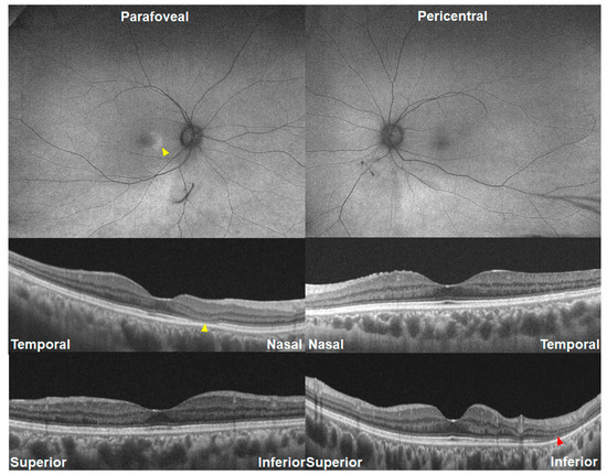 Atypical Presentations of Hydroxychloroquine Retinopathy: A Case Series ...