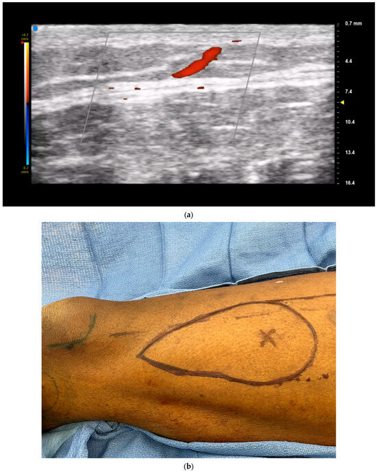 Ultrasound in Microsurgery: Current Applications and New Frontiers