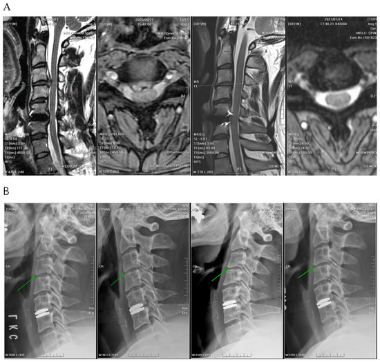 Disc Height and Angle Changes on Radiographs and Magnetic Resonance ...