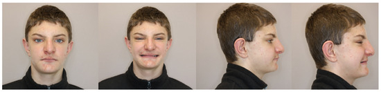 Floating–Harbor Syndrome: A Systematic Literature Review and Case Report