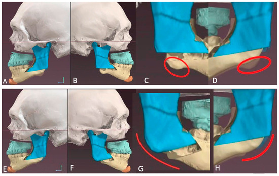 Hanna’s Modified Sagittal Split Osteotomy (HSSO): An Alternative to ...
