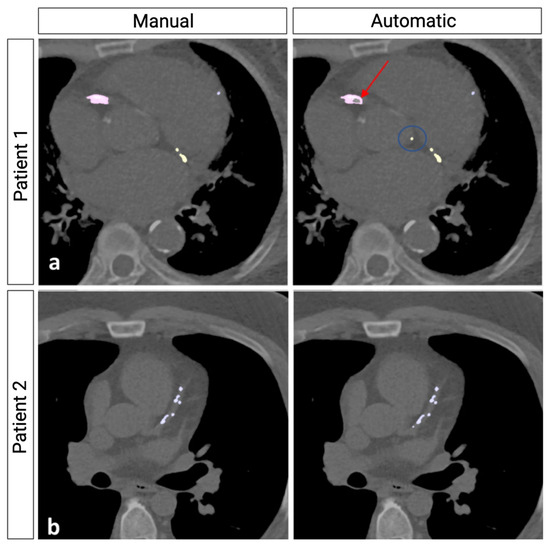 JCM | Free Full-Text | Artificial Intelligence in Coronary Artery Calcium Scoring