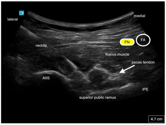 Peripheral Nerve Blocks for Hip Fractures