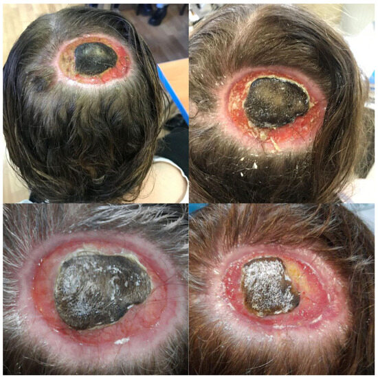 Chemical Scalp Burn after Hair Coloring—Case Report with Literature Review