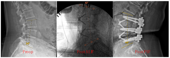 Impact of Supine versus Prone Positioning on Segmental Lumbar Lordosis ...