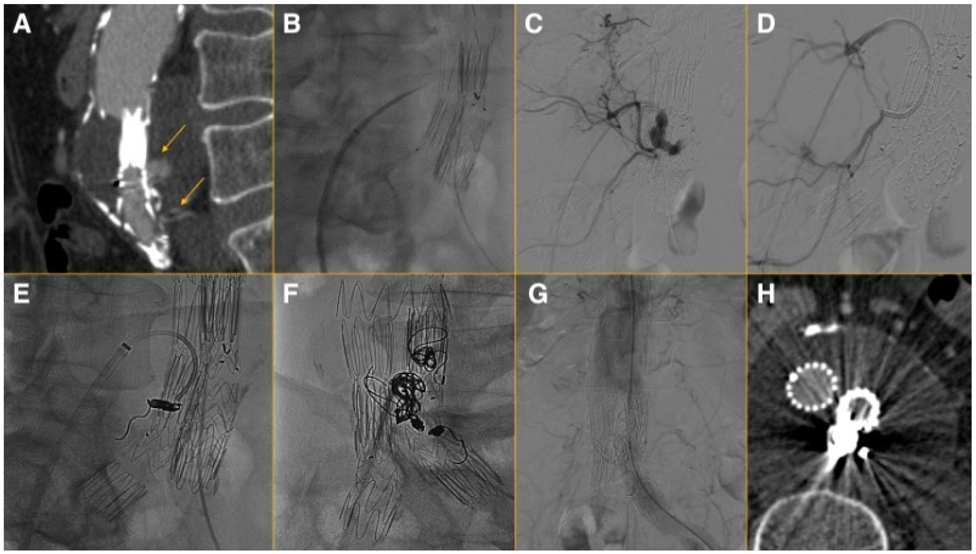 Early And Mid Term Outcomes Of Transcaval Embolization For Type 2