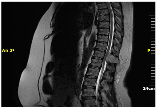 Comprehensive Insights into Metastasis-Associated Spinal Cord Compression: Pathophysiology ...