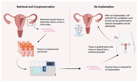 Ovarian Tissue Cryopreservation for Fertility Preservation in Patients with Hemoglobin Disorders ...
