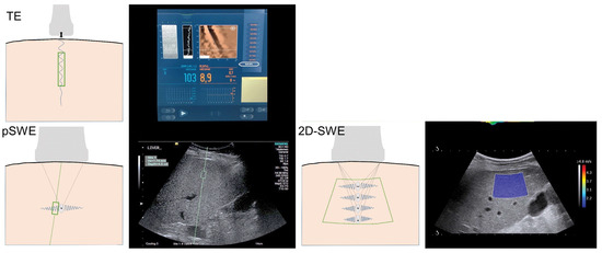 Ultrasound Shear Wave Elastography Evaluation of the Liver and ...