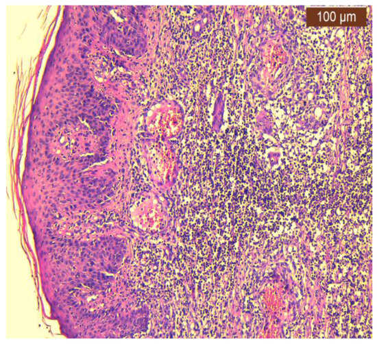 Pyoderma Gangrenosum, a Challenging Postpartum Diagnosis—Case Report ...