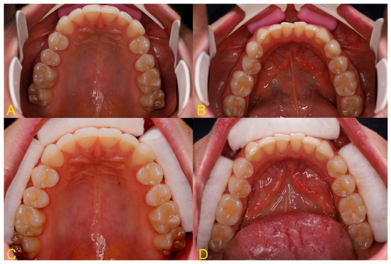 Soft Tissue Retraction Maneuver in Cone Beam Computed Tomography Prior ...