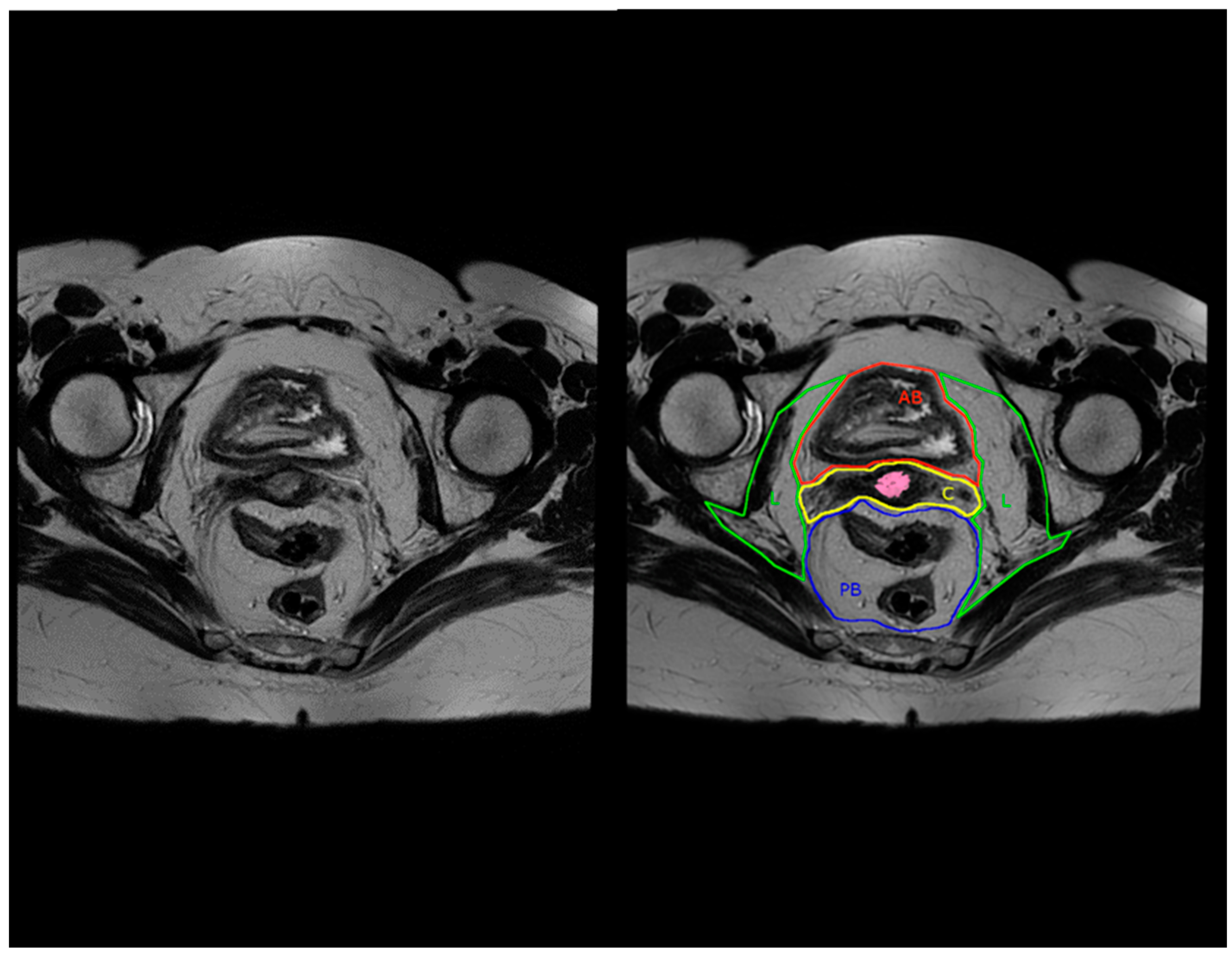 Robotic-Assisted Pelvic Exenteration for Cervical Cancer: A Systematic ...