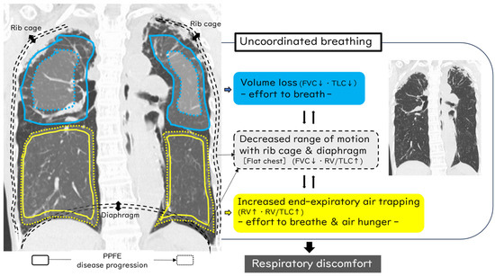 Proposed Clinical Algorithm for Pleuroparenchymal Fibroelastosis (PPFE)