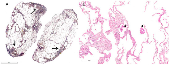 Proposed Clinical Algorithm for Pleuroparenchymal Fibroelastosis (PPFE)