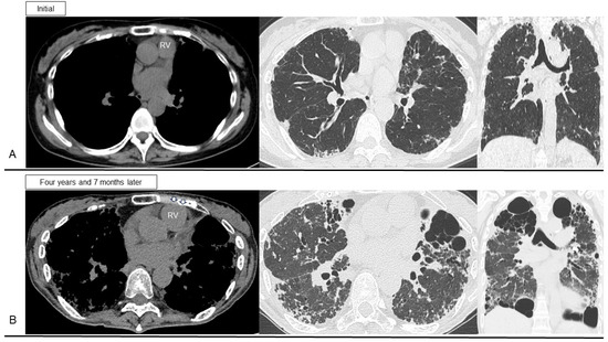 Proposed Clinical Algorithm for Pleuroparenchymal Fibroelastosis (PPFE)