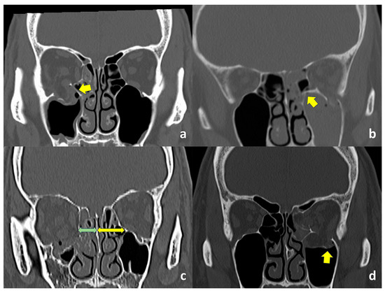 Clinical Significance of the Inferomedial Orbital Strut in Orbital ...
