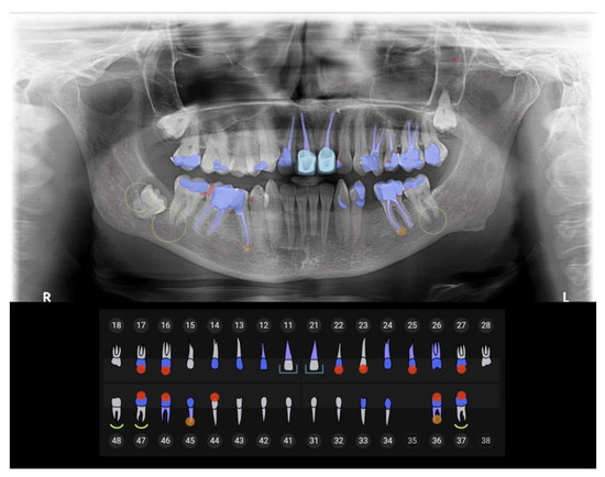 Oral Health Status and Treatment Needs Based on Artificial Intelligence ...