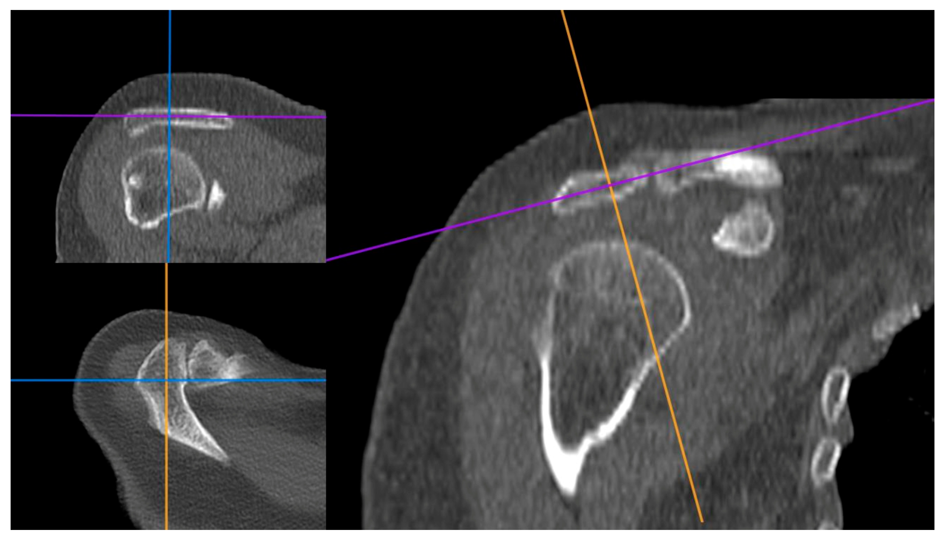 Bone Density Changes at the Origin of the Deltoid Muscle following ...