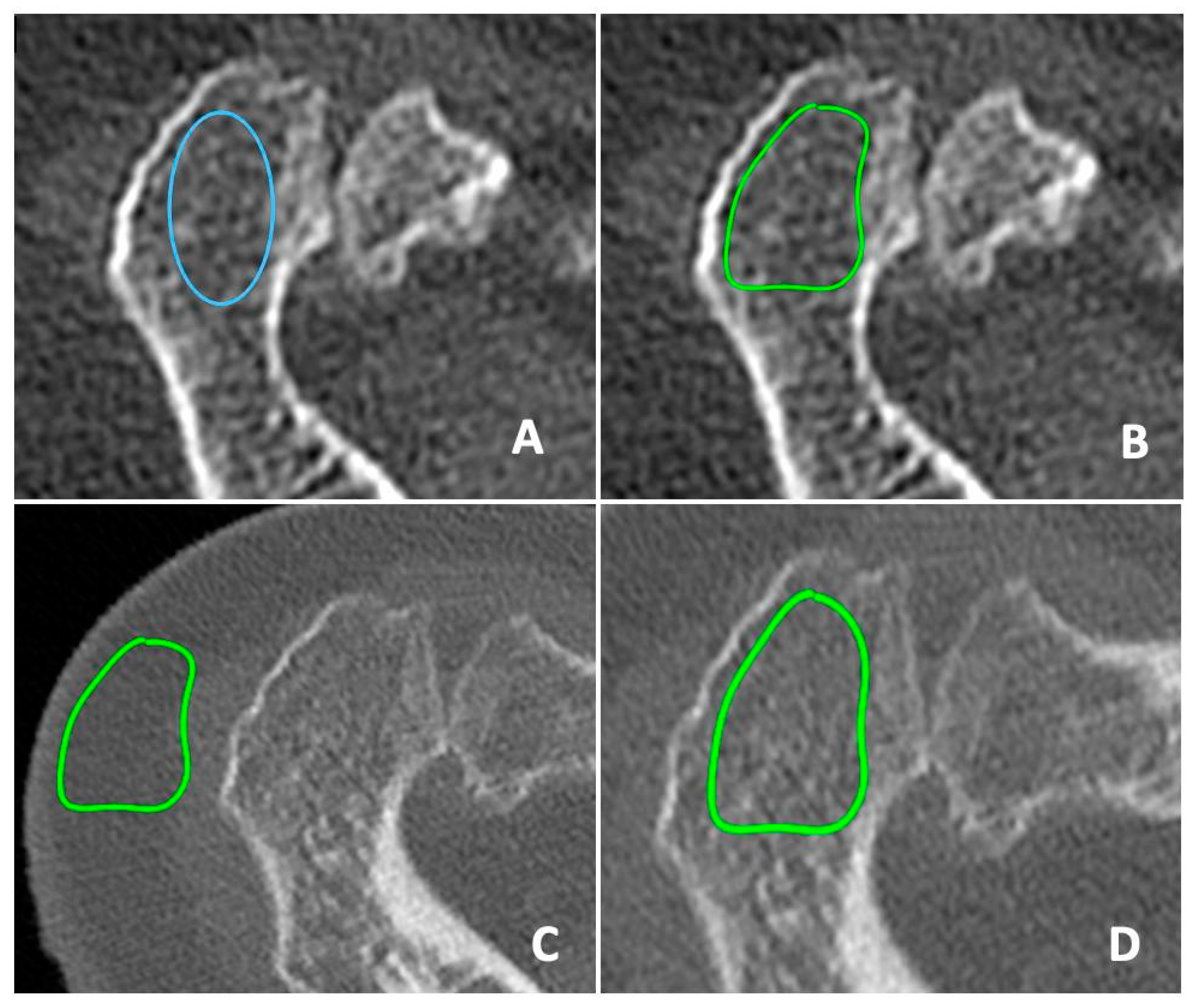 Deltoid Muscle Anatomy Ct