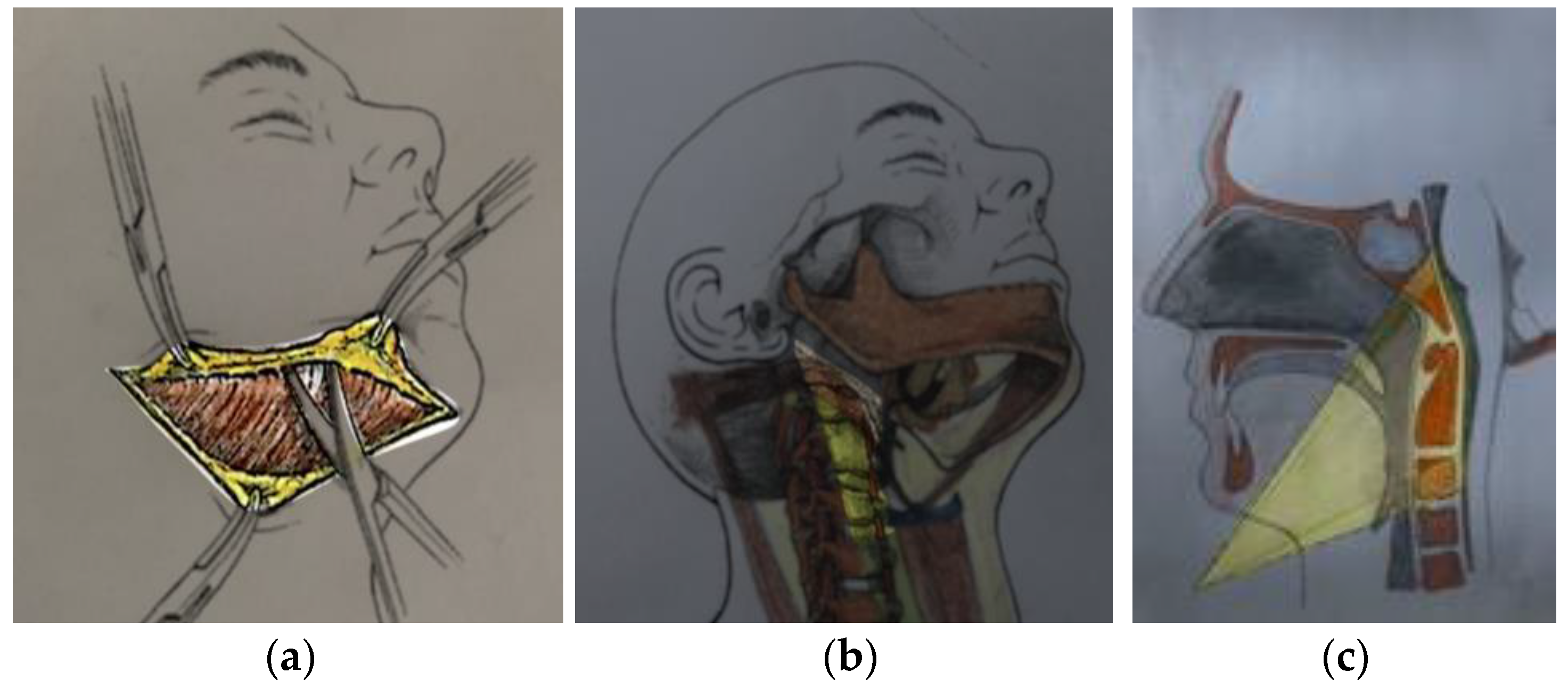 A Three-Step Submandibular Retropharyngeal Approach to the ...