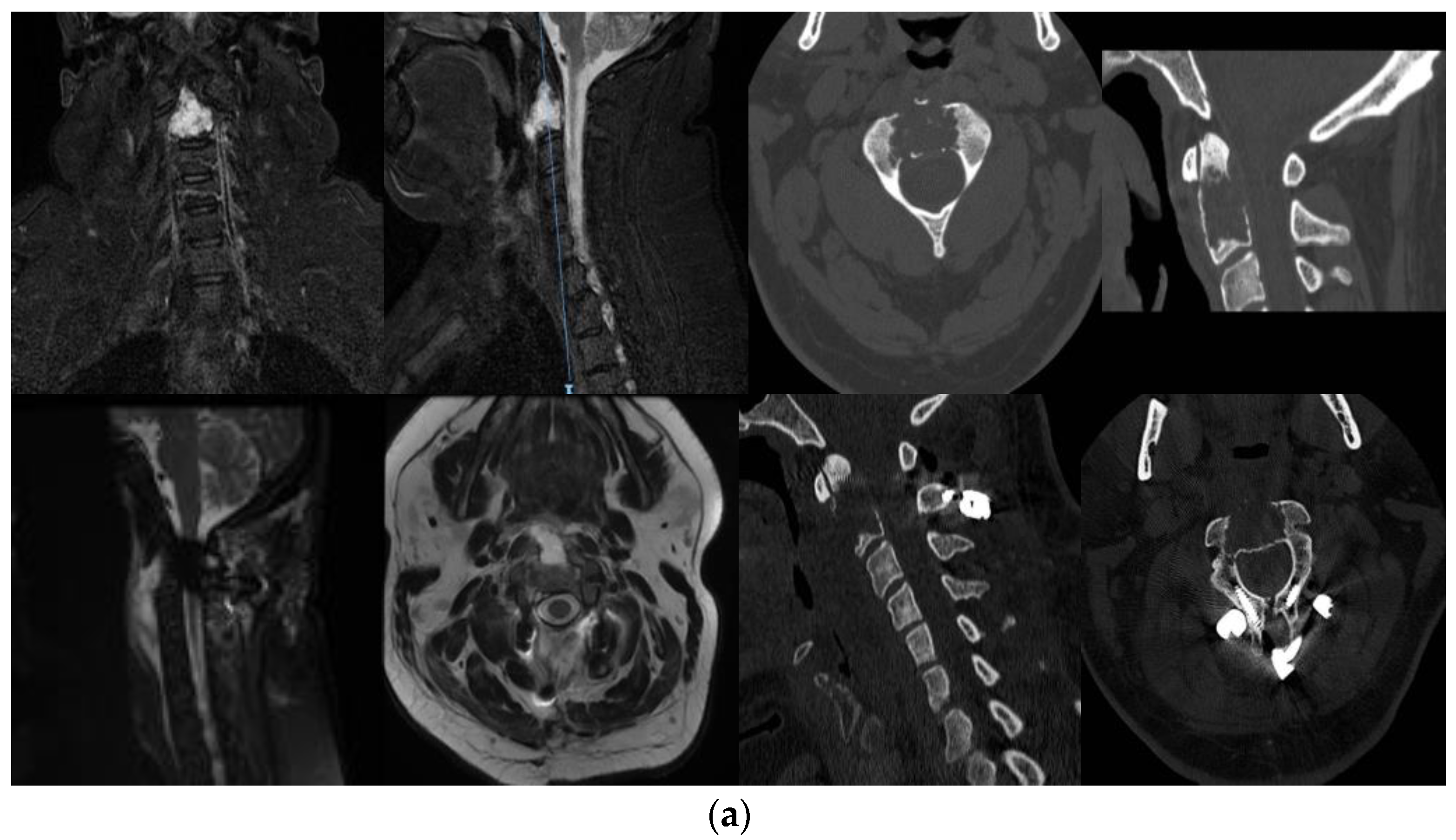 A Three-Step Submandibular Retropharyngeal Approach to the ...